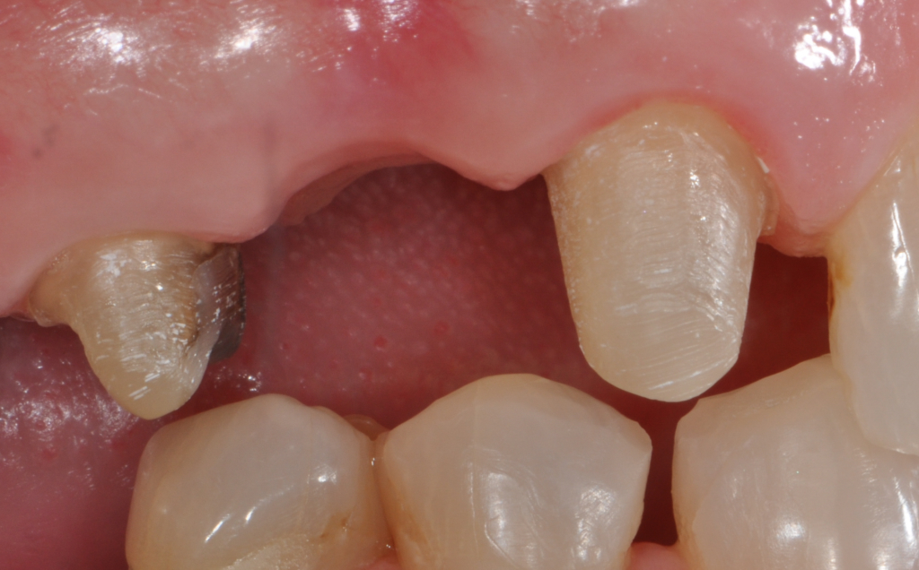 Bridge - Prep - Palmetto Prosthodontics - Esthetic Dentistry and Denture