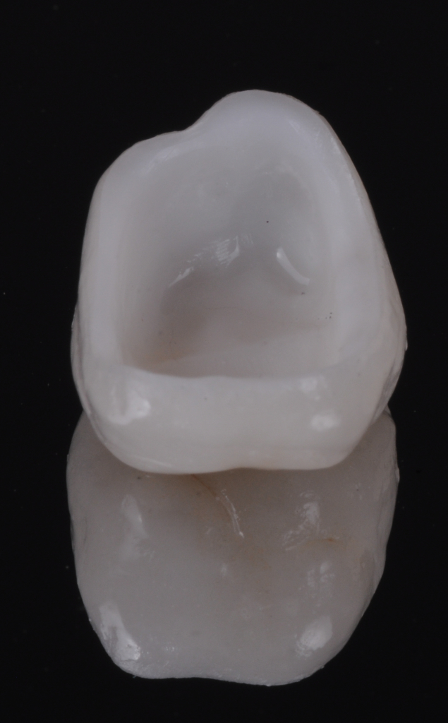 Crown - Lab Photo - Palmetto Prosthodontics - Esthetic Dentistry and ...
